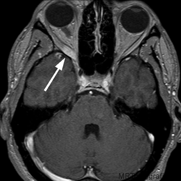 Orbita MR - Nedir, Nasıl Çekilir, Aşamaları ve Amaçları