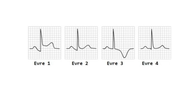 Perikardit EKG Nasıl Çekilir -Aşamaları, Amaçları ve Özellikleri