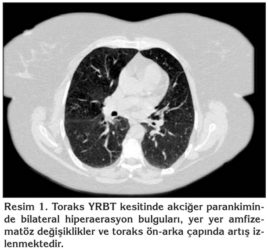 Toraks tomografisi - Nedir, Neden istenir ve Nasıl çekilir