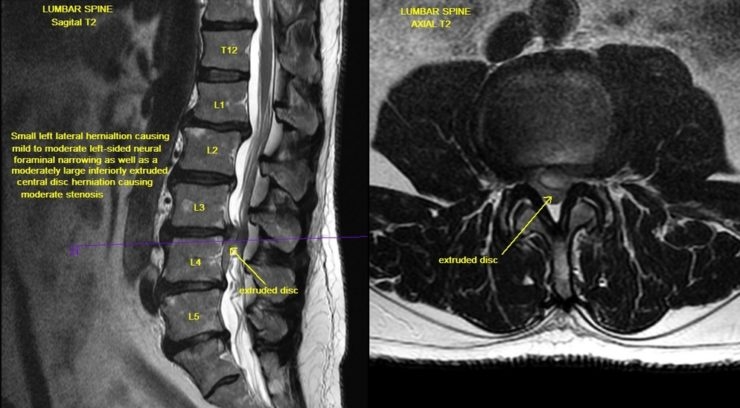 Lomber MR Nedir ve Nasıl çekilir - Bel Emarı çekimi