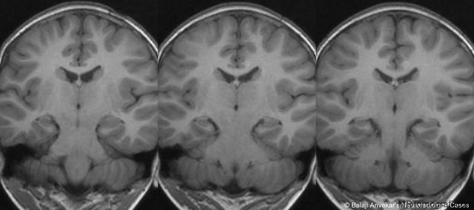 Temporal Kemik MR İncelemesi - Nedir, Amaçları ve Çekim Aşamaları